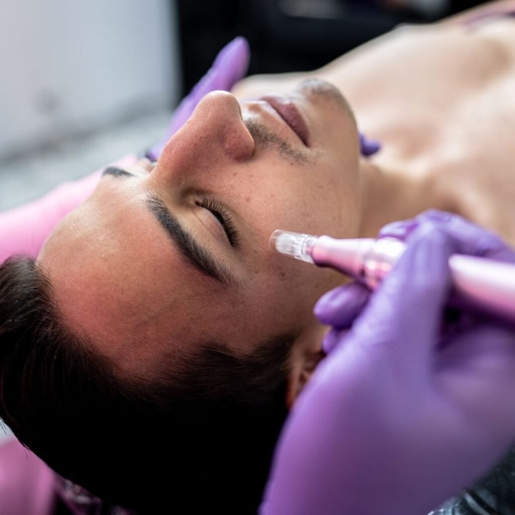 Can You Microneedle Under Eyes? - https://microneedlingbeforeafter.com