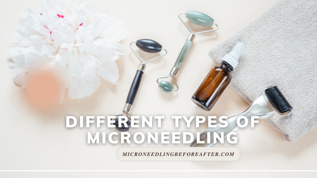 Different Types Of Microneedling - https://microneedlingbeforeafter.com