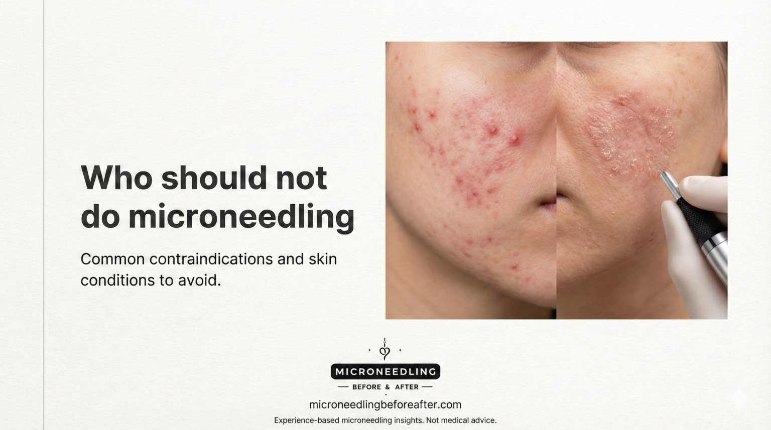 Who Should Not Do Microneedling - https://microneedlingbeforeafter.com
